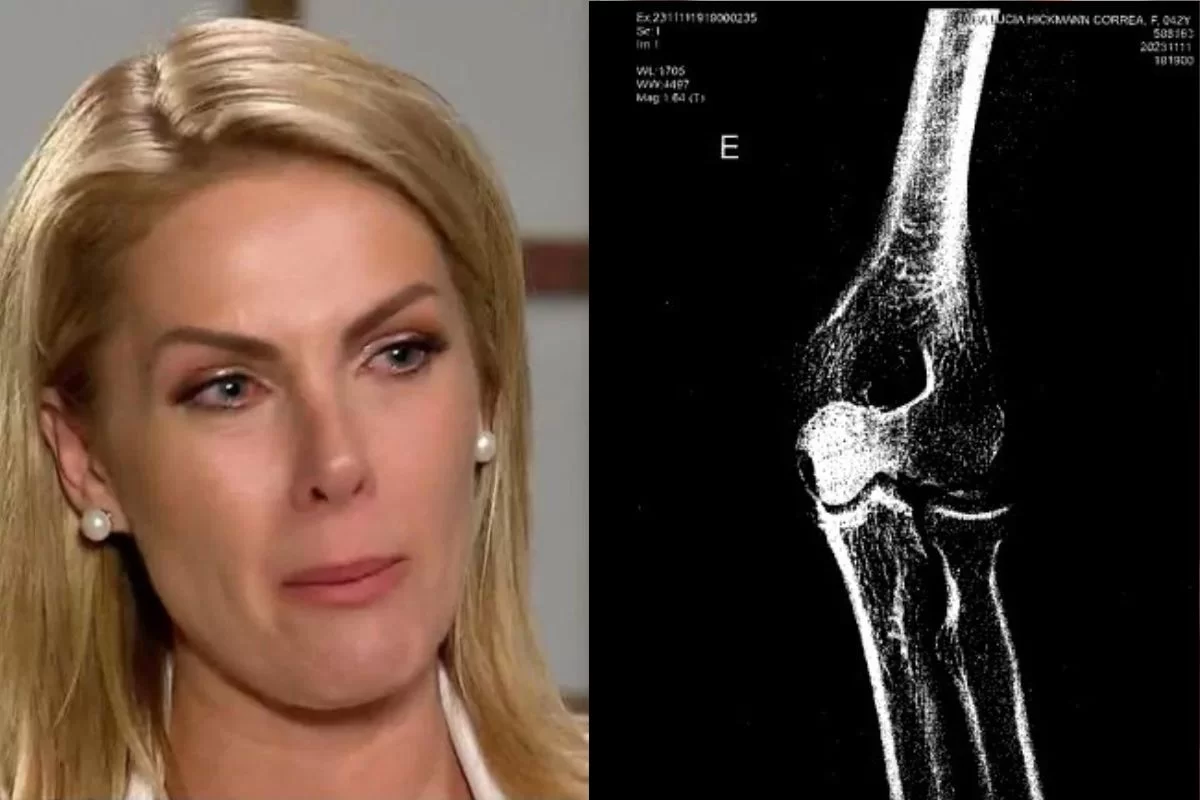 Raio-x e exame de corpo de delito mostram lesões de Ana Hickmann; veja
